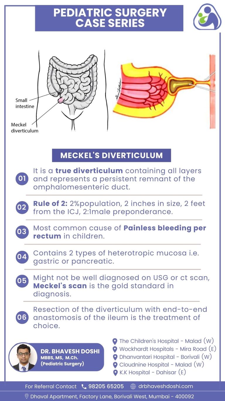 Meckel’s Diverticulum